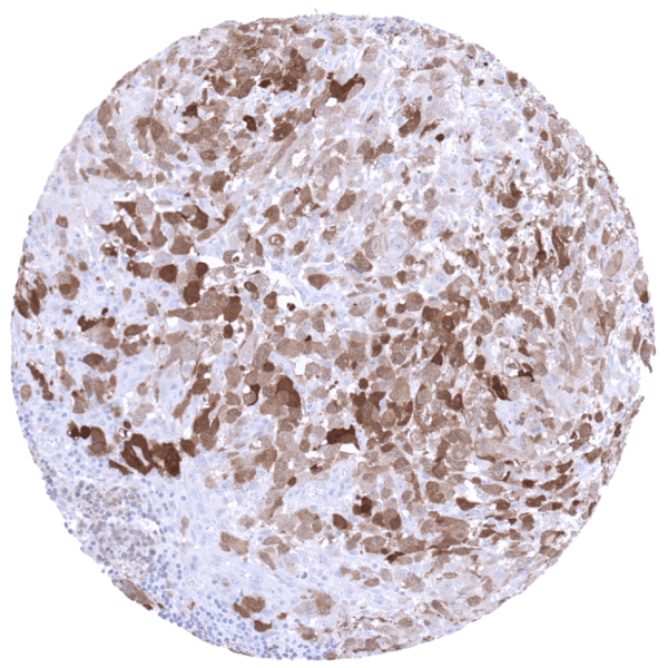 Cancer Tissue Gallery PGP9.5 / UCHL1 - MS Validated Antibodies