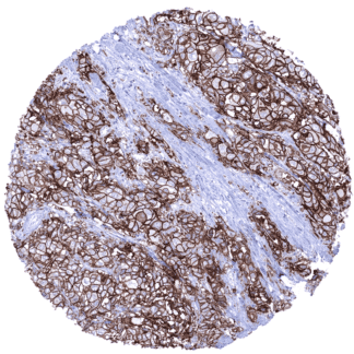 Cancer Tissue Gallery TACSTD2 / Trop-2 - MS Validated Antibodies