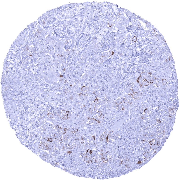 Cancer Tissue Gallery TACSTD2 / Trop-2 - MS Validated Antibodies