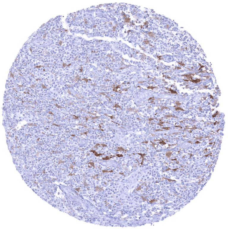 Cancer Tissue Gallery Factor XIII alpha - MS Validated Antibodies