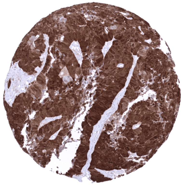 Cancer Tissue Gallery PGP9.5 / UCHL1 - MS Validated Antibodies