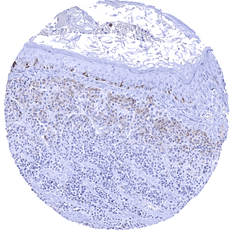 Cancer Tissue Gallery PMEL / gp100 / Melanosome - MS Validated Antibodies