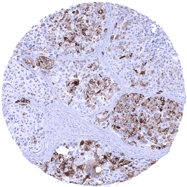 Cancer Tissue Gallery PMEL / gp100 / Melanosome - MS Validated Antibodies