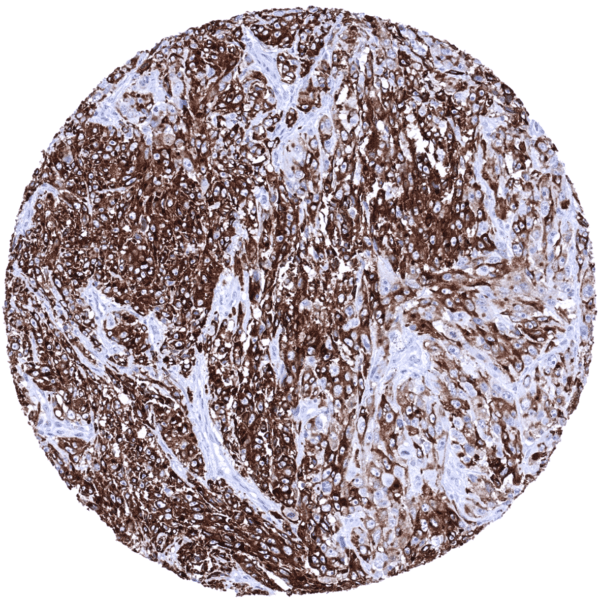 Cancer Tissue Gallery PMEL / gp100 / Melanosome - MS Validated Antibodies