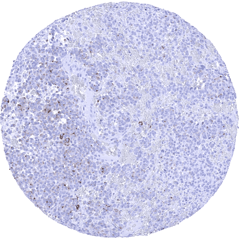 Cancer Tissue Gallery PMEL / gp100 / Melanosome - MS Validated Antibodies