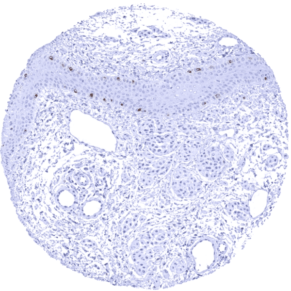 Cancer Tissue Gallery PMEL / gp100 / Melanosome - MS Validated Antibodies