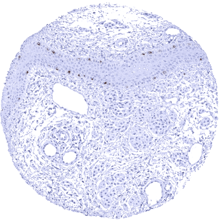Cancer Tissue Gallery PMEL / gp100 / Melanosome - MS Validated Antibodies