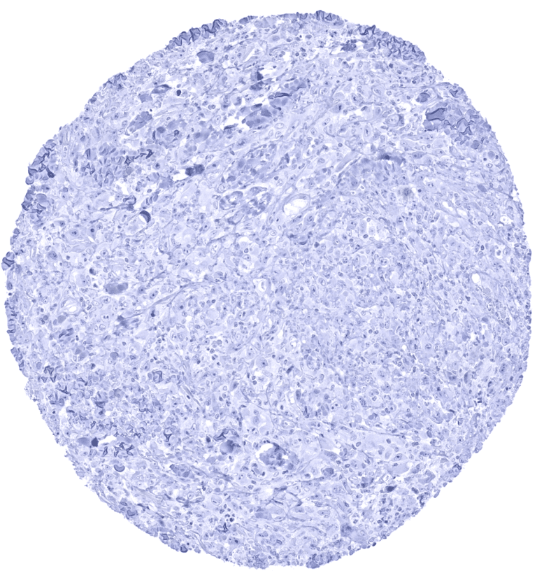 Cancer Tissue Gallery PMEL / gp100 / Melanosome - MS Validated Antibodies