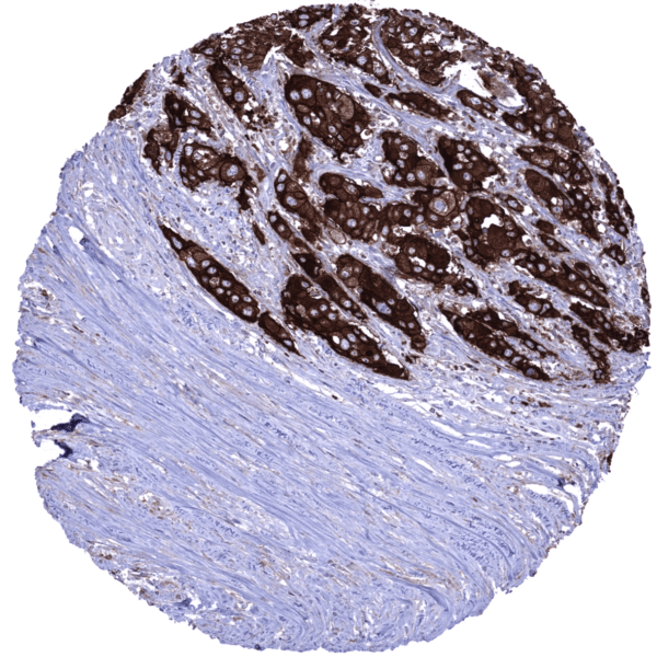 Cancer Tissue Gallery MUC1 / EMA - MS Validated Antibodies