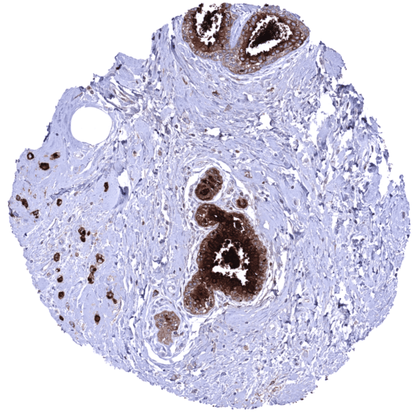 Cancer Tissue Gallery MUC1 / EMA - MS Validated Antibodies