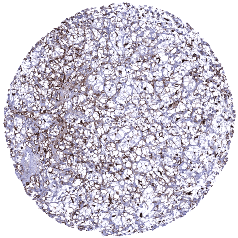 Cancer Tissue Gallery MUC1 / EMA - MS Validated Antibodies