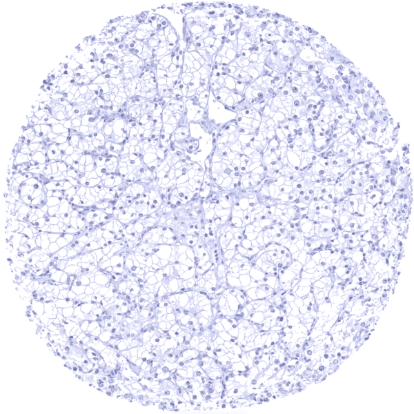 Cancer Tissue Gallery Desmoglein 3 - MS Validated Antibodies