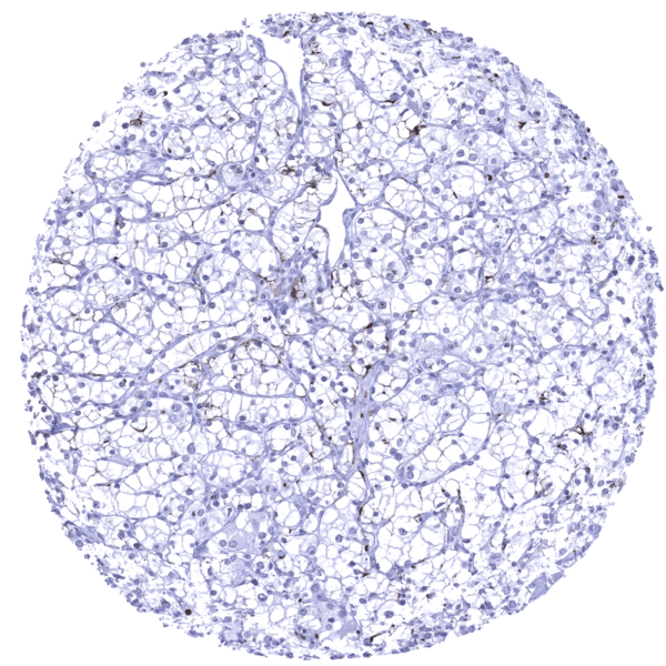 Cancer Tissue Gallery MUC1 / EMA - MS Validated Antibodies