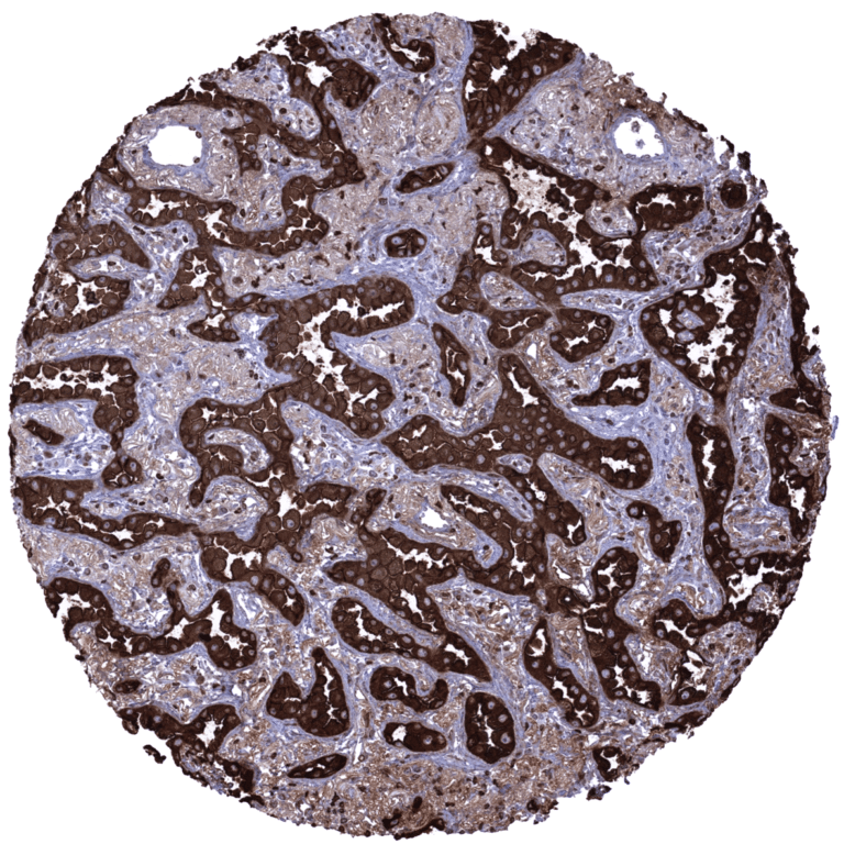 Cancer Tissue Gallery MUC1 / EMA - MS Validated Antibodies