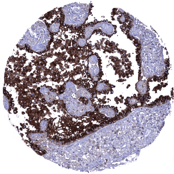 Cancer Tissue Gallery MUC1 / EMA - MS Validated Antibodies