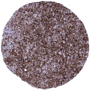 Cancer Tissue Gallery MUC1 / EMA - MS Validated Antibodies