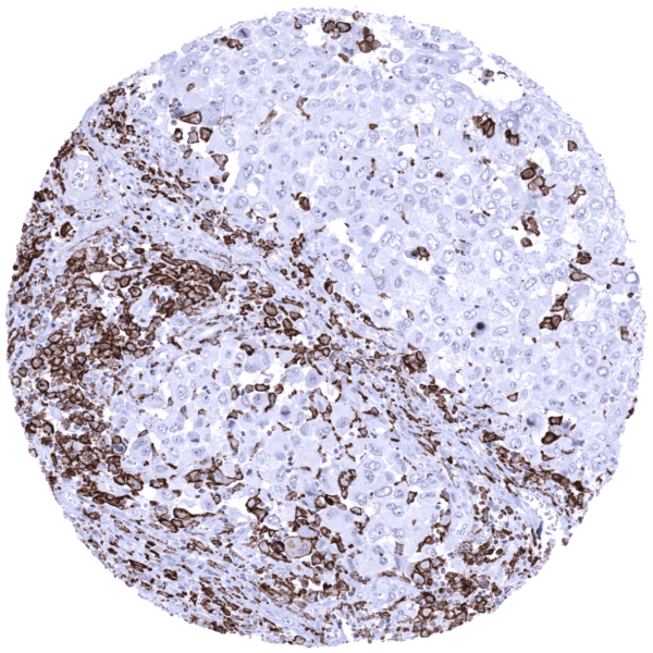 Cancer Tissue Gallery AIF 1 - MS Validated Antibodies