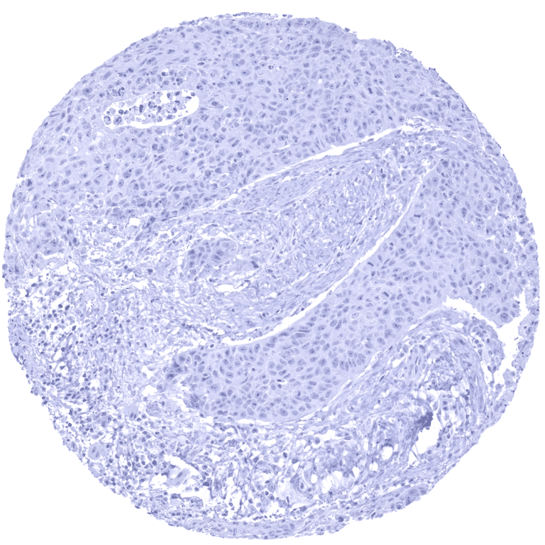 Cancer Tissue Gallery Calbindin 1 - MS Validated Antibodies