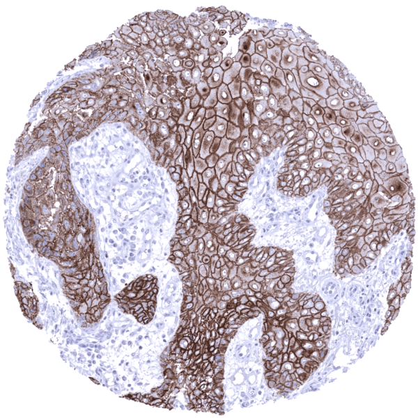 Cancer Tissue Gallery Desmoglein 3 - MS Validated Antibodies