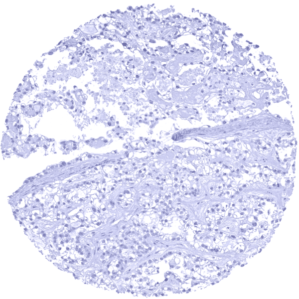 Cancer Tissue Gallery Desmoglein 3 - MS Validated Antibodies