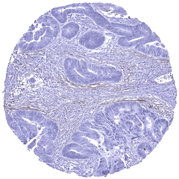 Cancer Tissue Gallery Periostin - MS Validated Antibodies