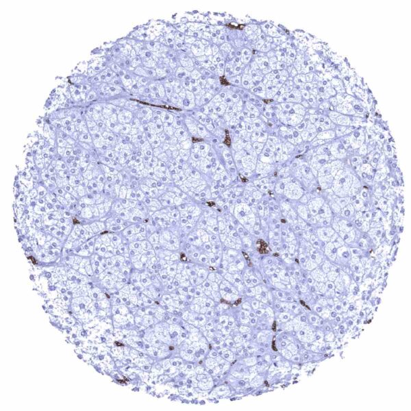 Cancer Tissue Gallery GLUT1 - MS Validated Antibodies