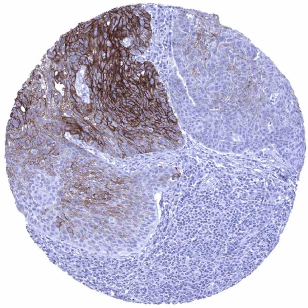 Desmoglein 1 Cancer Tissue Gallery - MS Validated Antibodies