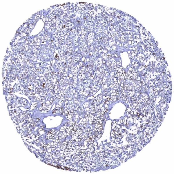 Cancer Tissue Gallery GLUT1 - MS Validated Antibodies