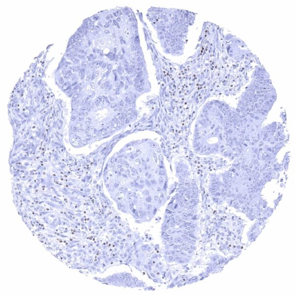 Cancer Tissue Gallery ZAP-70 - MS Validated Antibodies