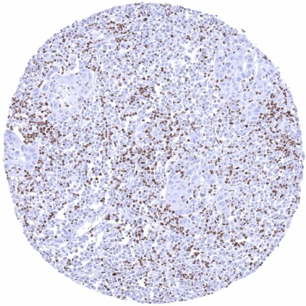 Cancer Tissue Gallery ZAP-70 - MS Validated Antibodies