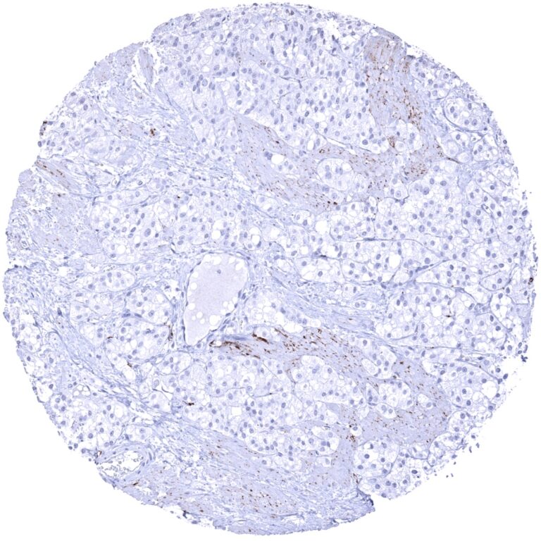Cancer Tissue Gallery CD56 - MS Validated Antibodies