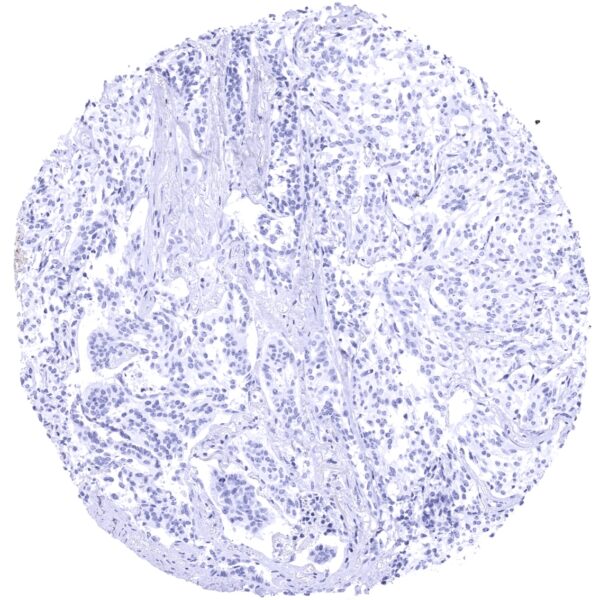 Cancer Tissue Gallery Cadherin-17 / CDH17 - MS Validated Antibodies