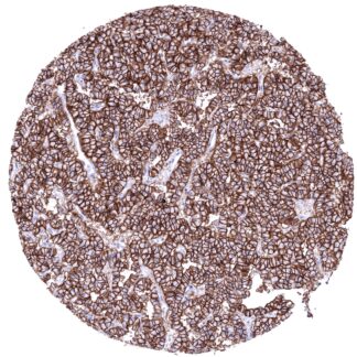 Cancer Tissue Gallery Cadherin-17 / CDH17 - MS Validated Antibodies