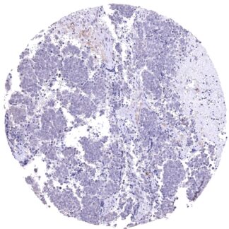 Cancer Tissue Gallery CD141 - MS Validated Antibodies