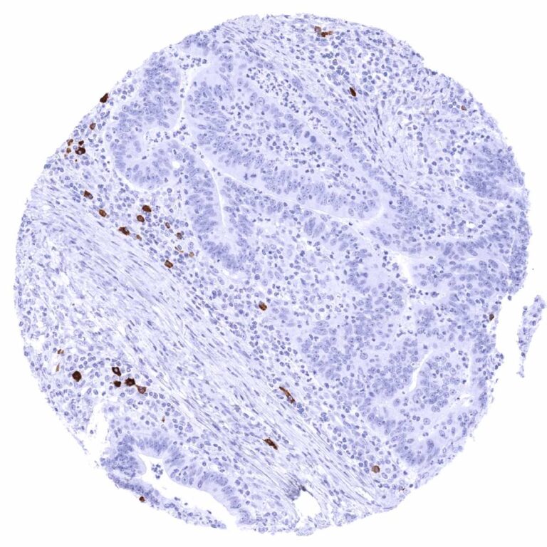 Cancer Tissue Gallery IgA (Immunglobulin Alpha Heavy Chain) - MS ...