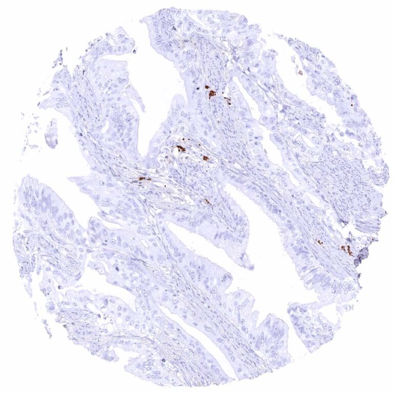Cancer Tissue Gallery IgA (Immunglobulin Alpha Heavy Chain) - MS ...
