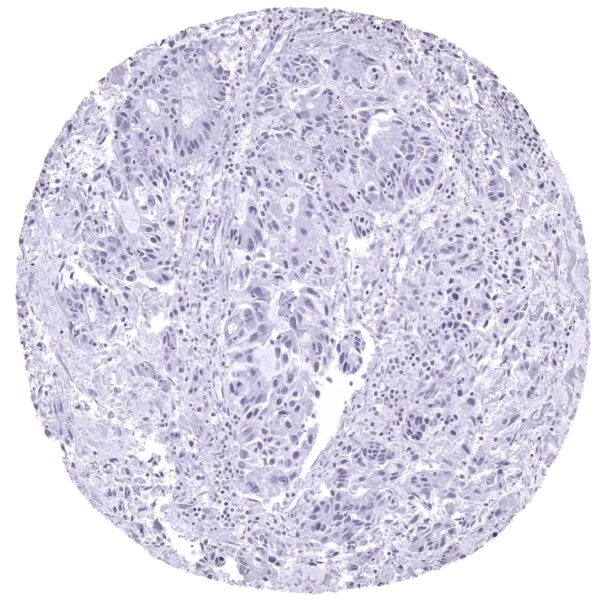 Cancer Tissue Gallery HER2 - MS Validated Antibodies