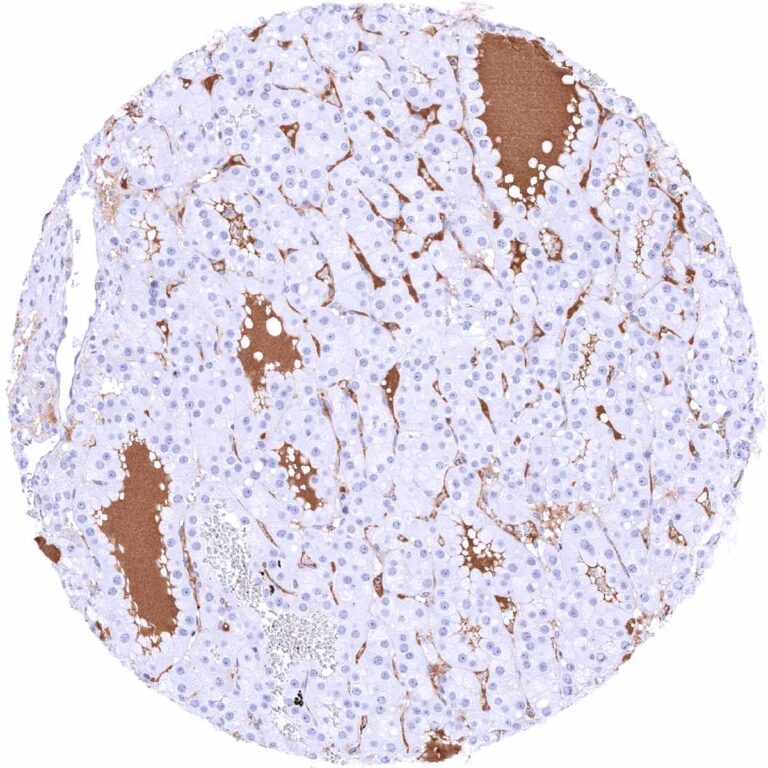 Cancer Tissue Gallery IgA (Immunglobulin Alpha Heavy Chain) - MS ...