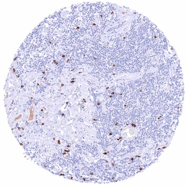 Cancer Tissue Gallery IgA (Immunglobulin Alpha Heavy Chain) - MS ...