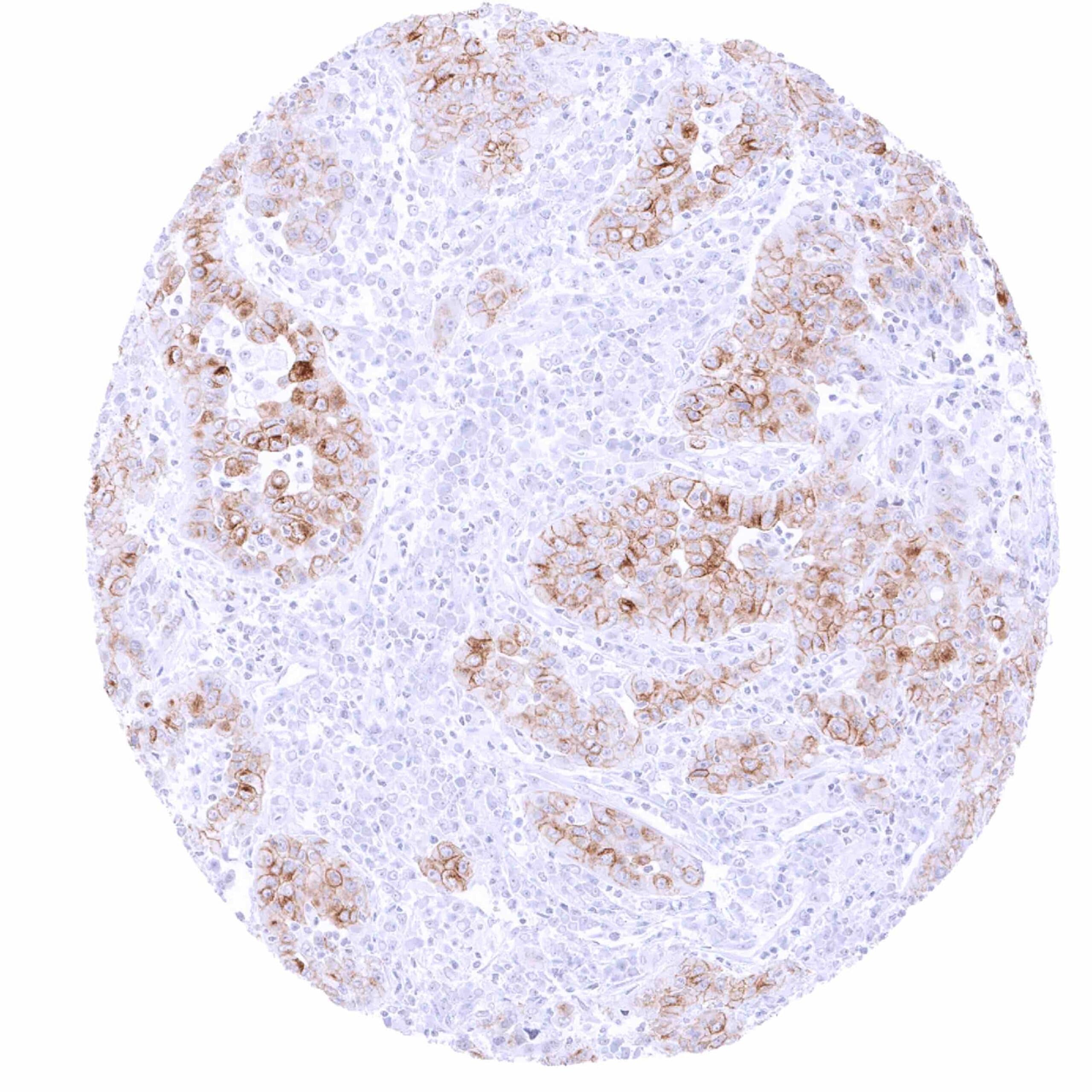 Cancer Tissue Gallery Uroplakin 3B - MS Validated Antibodies