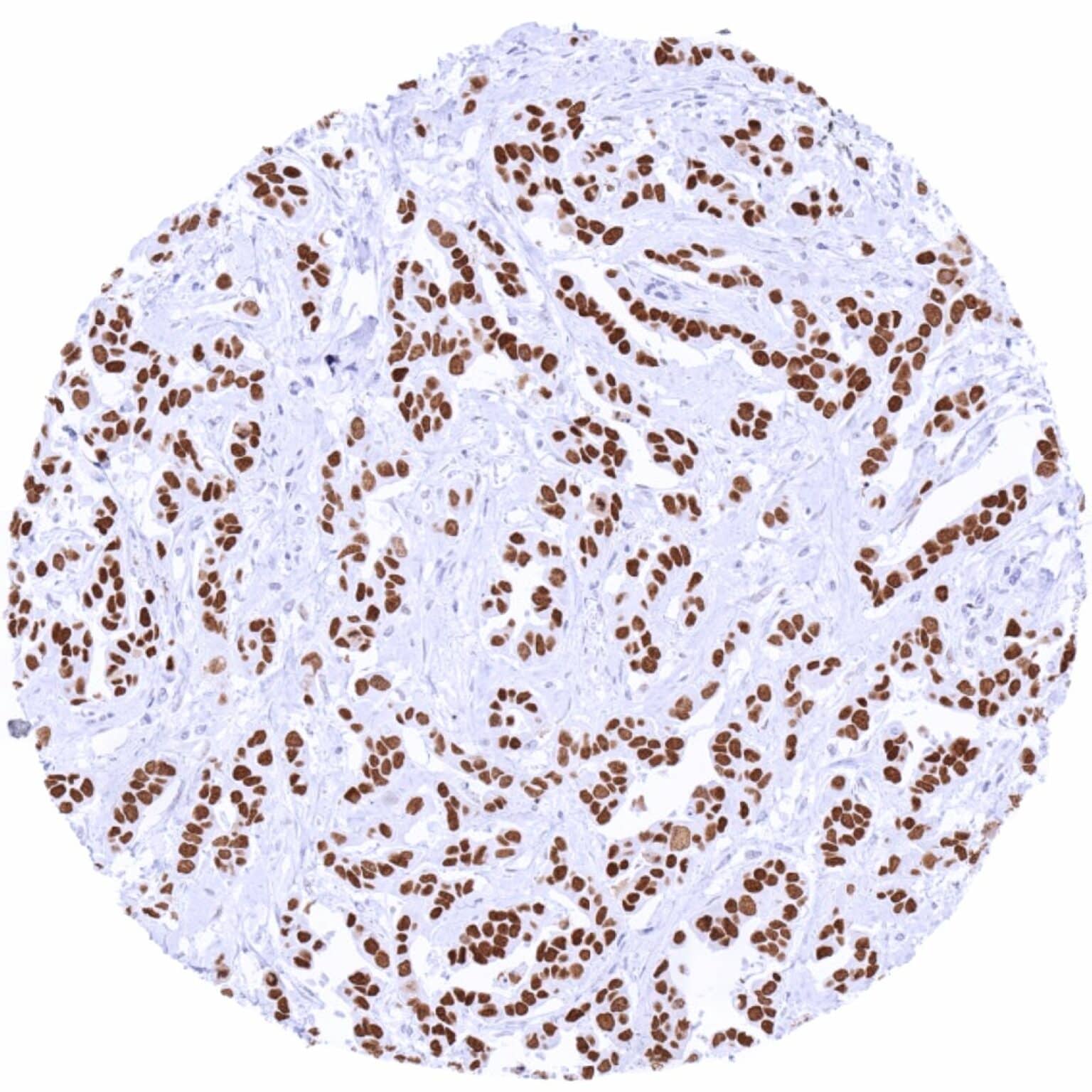 Cancer Tissue Gallery TRPS1 - MS Validated Antibodies
