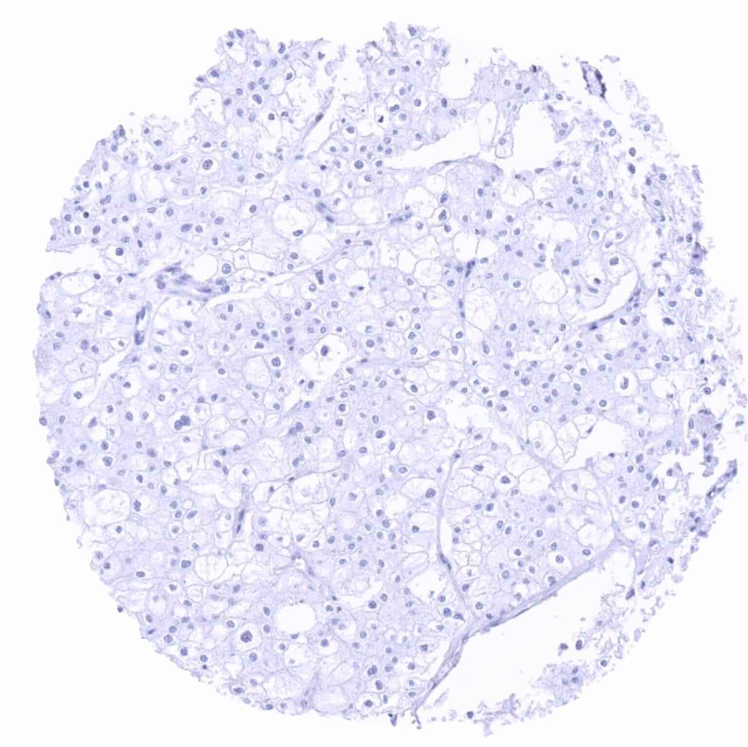 Cancer Tissue Gallery TTF-1 / Thyroid Transcription Factor 1 / NKX2-1 ...