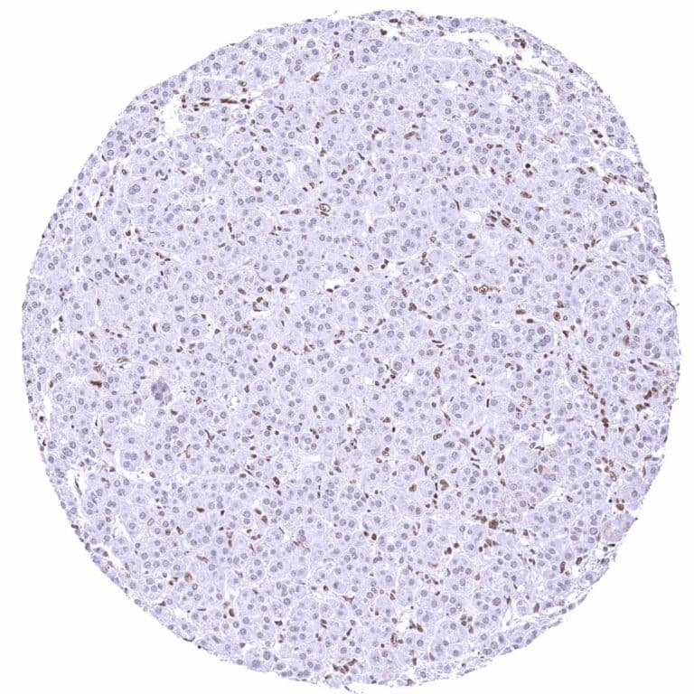 Cancer Tissue Gallery Glucocorticoid Receptor - MS Validated Antibodies