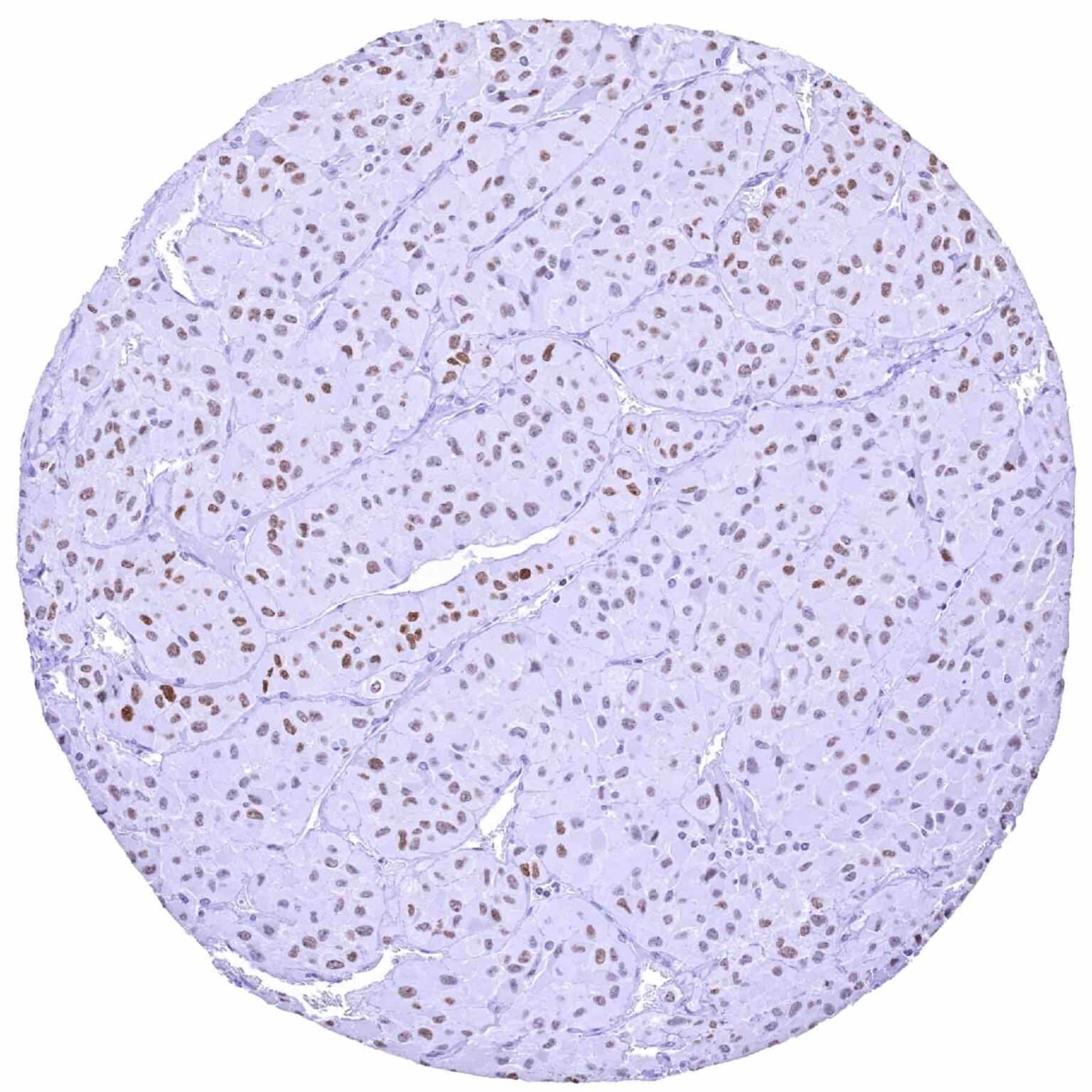 Cancer Tissue Gallery HMGA2 - MS Validated Antibodies