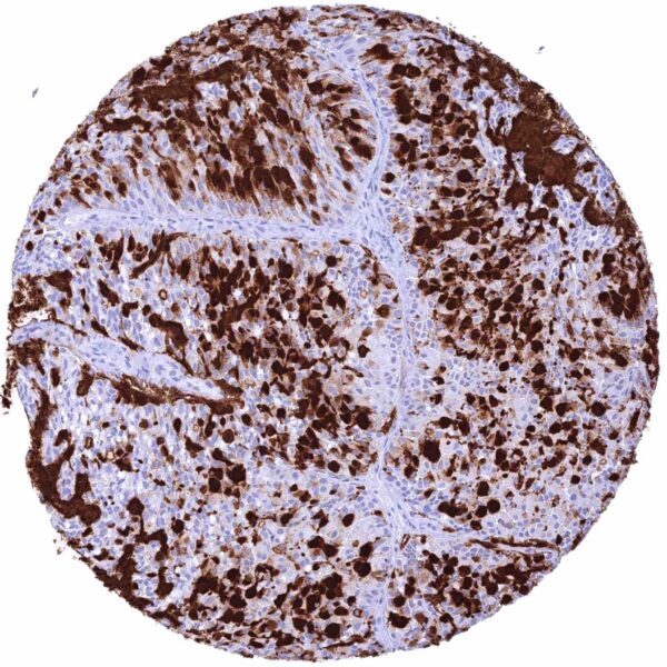 Cancer Tissue Gallery MUC2 - MS Validated Antibodies