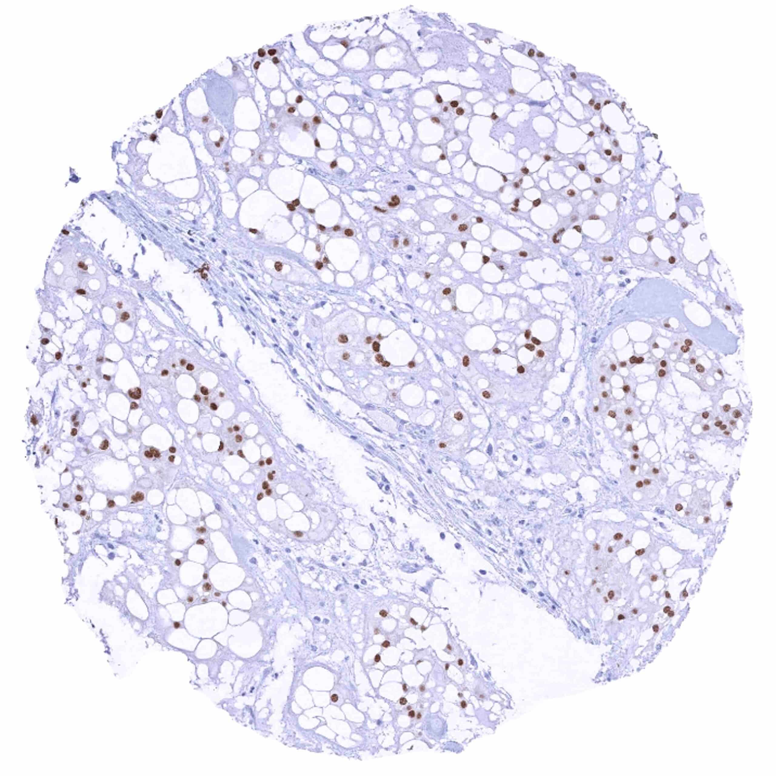 Cancer Tissue Gallery Brachyury - MS Validated Antibodies