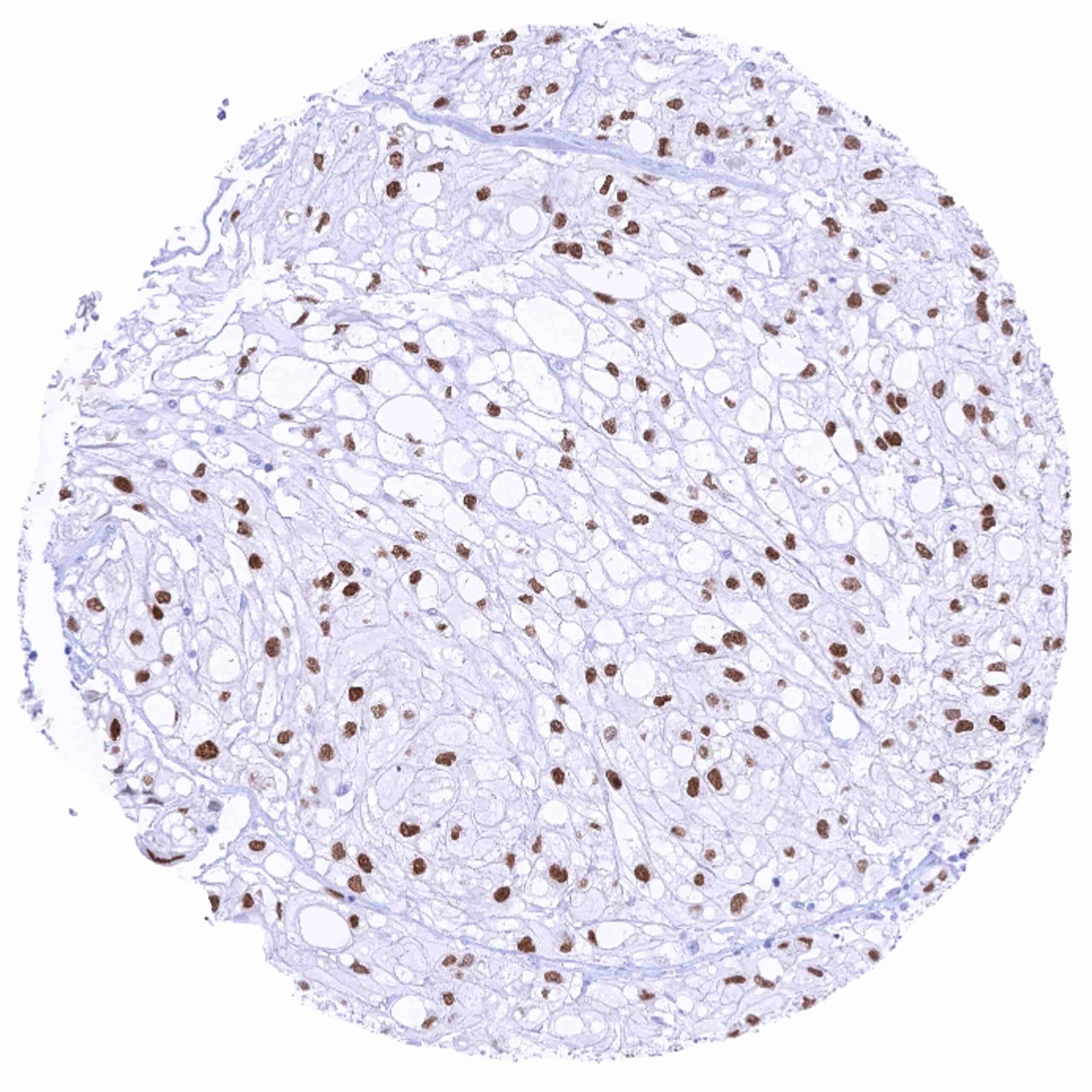 Cancer Tissue Gallery Brachyury - MS Validated Antibodies