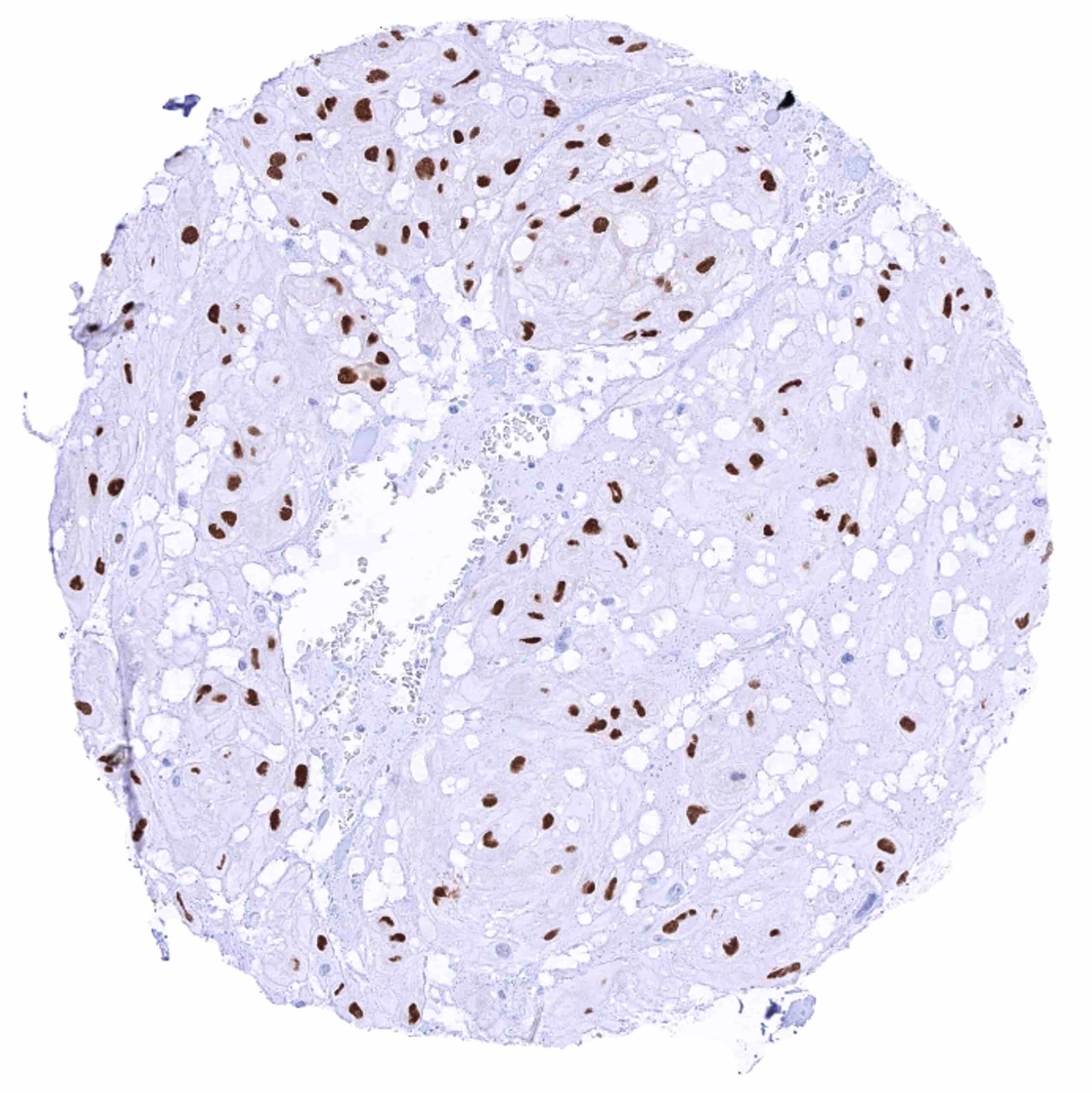 Cancer Tissue Gallery Brachyury - MS Validated Antibodies