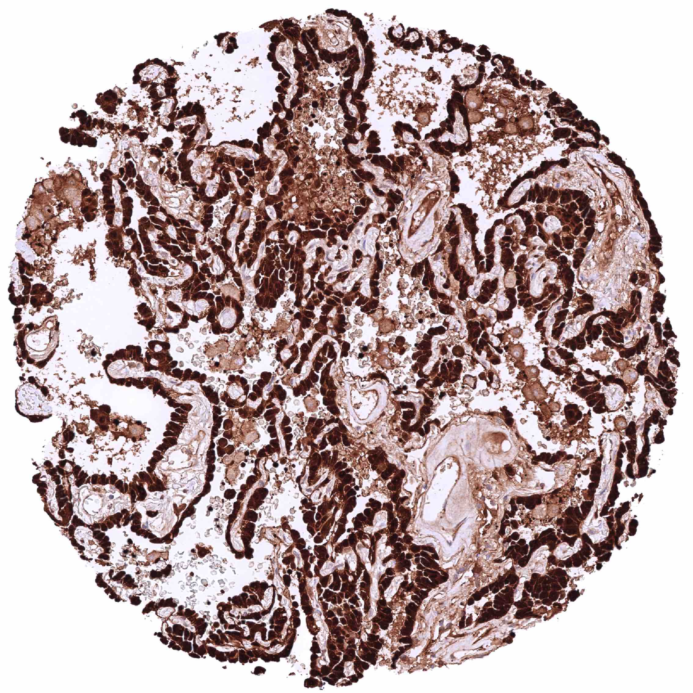 Cancer Tissue Gallery GSTP1 - MS Validated Antibodies